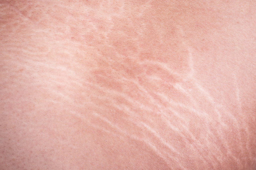 First Signs of Stretch Marks And How To Prevent Them