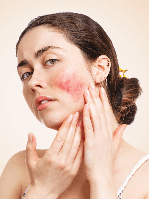 Expert Rosacea Treatment Guide - Advanced Skincare Solutions for Rosacea