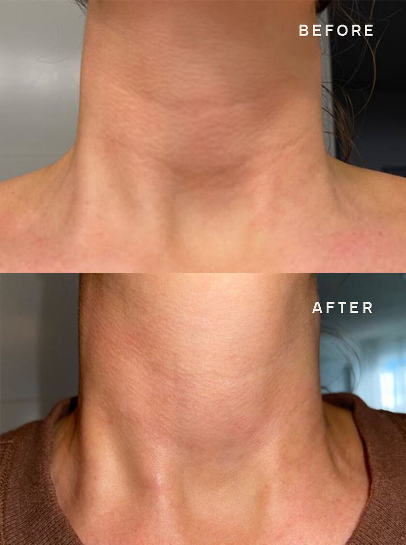 SILICONEFUSION NECK PATCH - DERMARCLARA